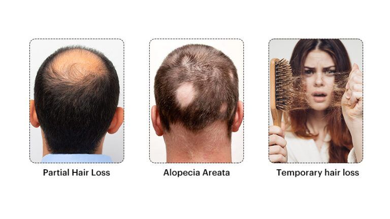 What Is a Clip-On Hair System and How Does It Work?
